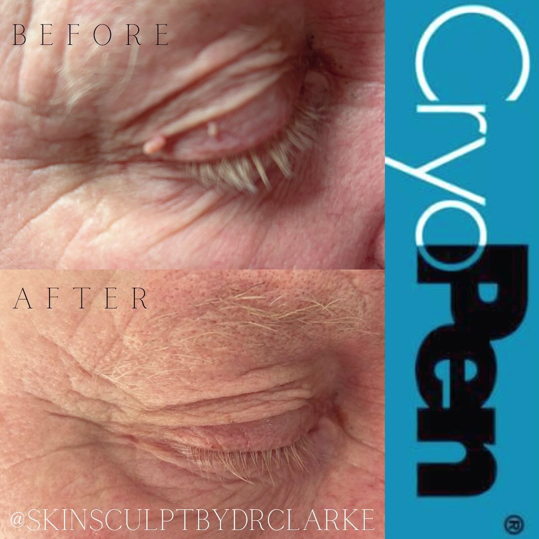 Benign Lesion Removal – Skin Sculpt