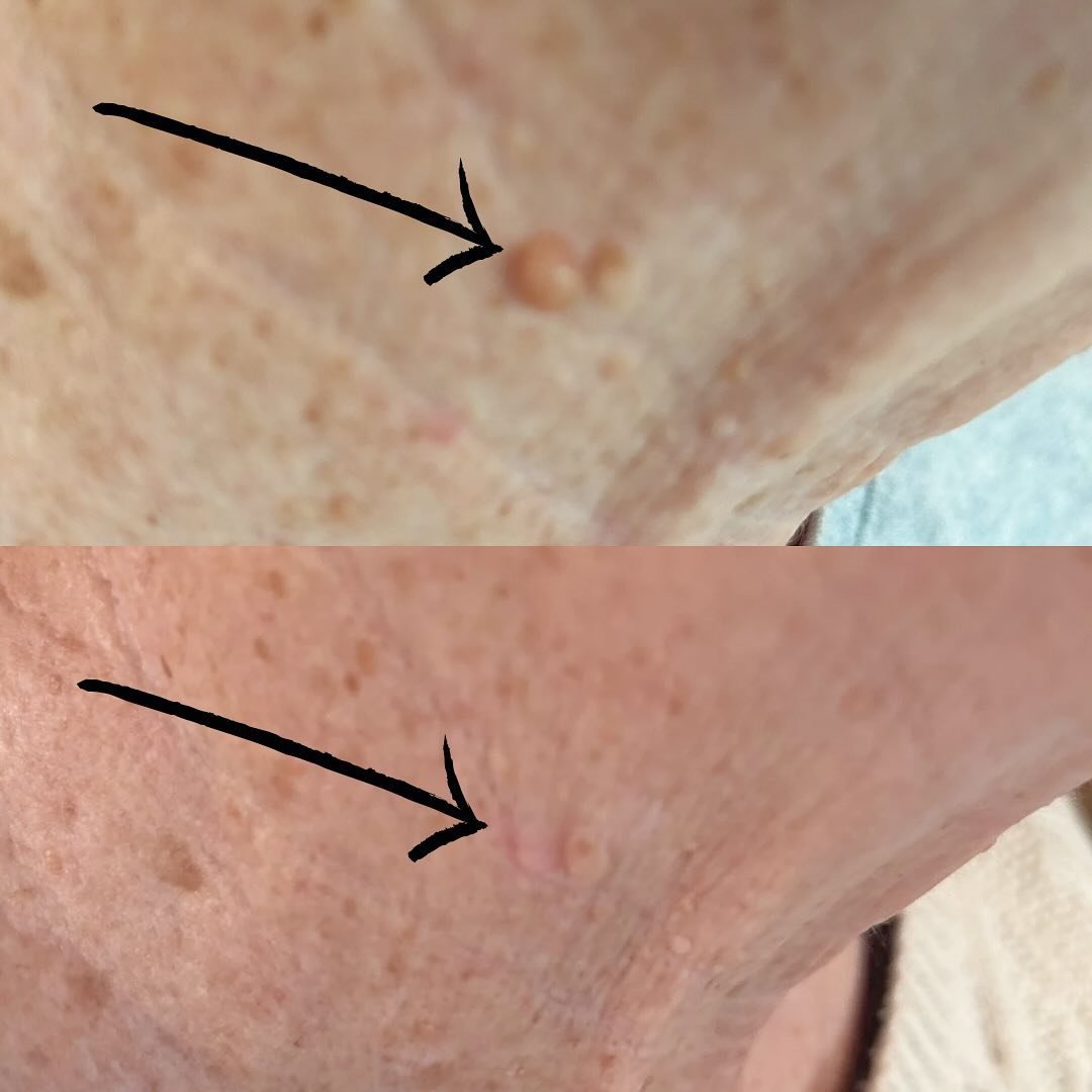 Benign Lesion Removal – Skin Sculpt